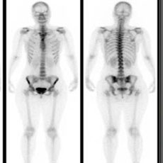 About the Bone Scan